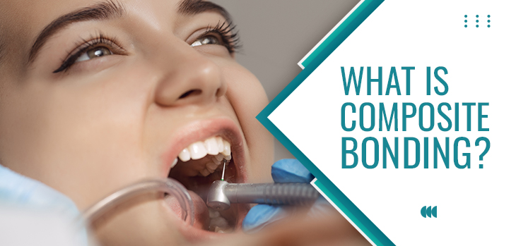 What is Composite Bonding?